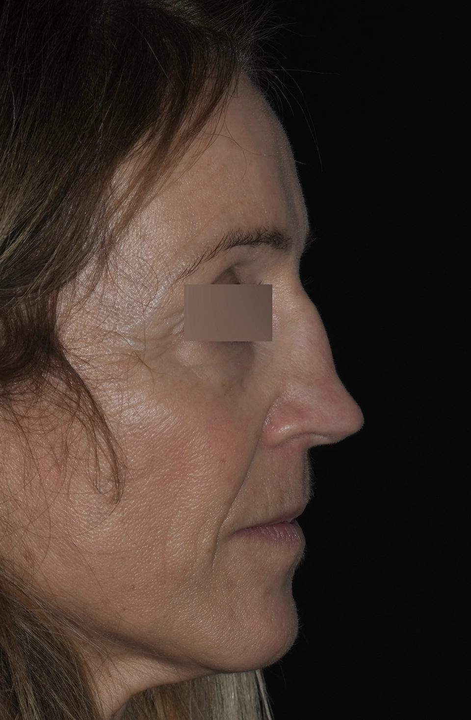 Revision rhinoplasty - Dr Carles