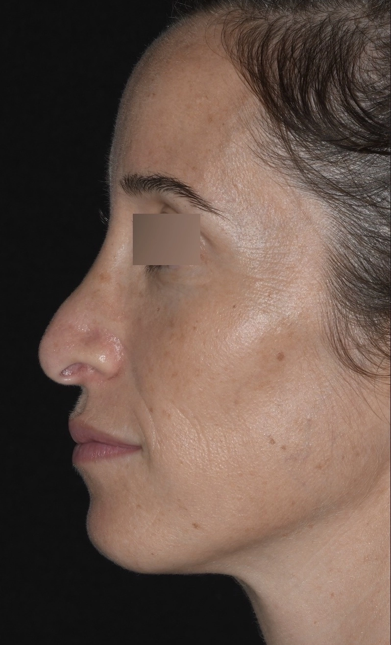 Revision rhinoplasty - Dr Carles