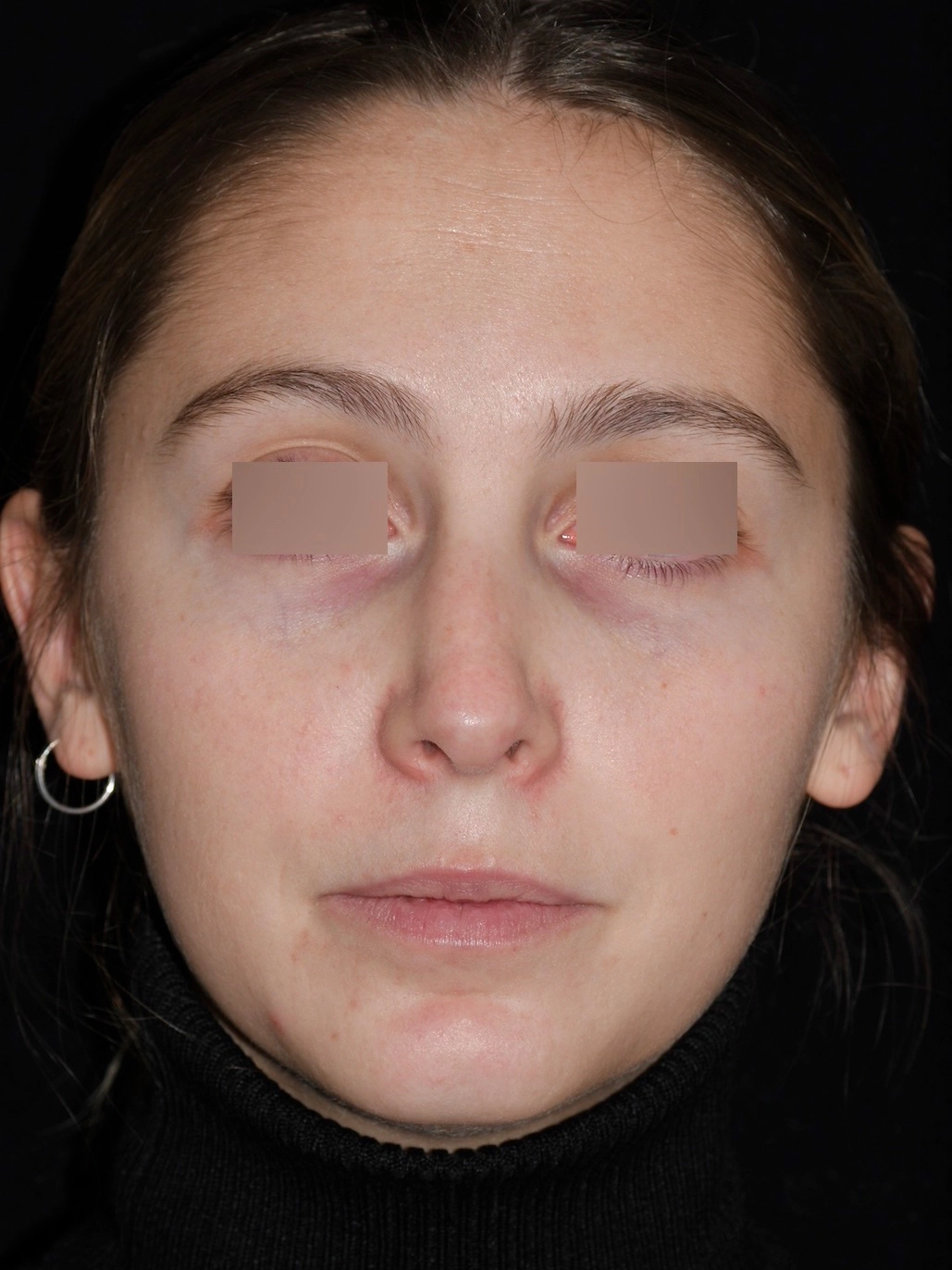 Rhinoplastie secondaire, informations sur la rhinoplastie secondaire ...