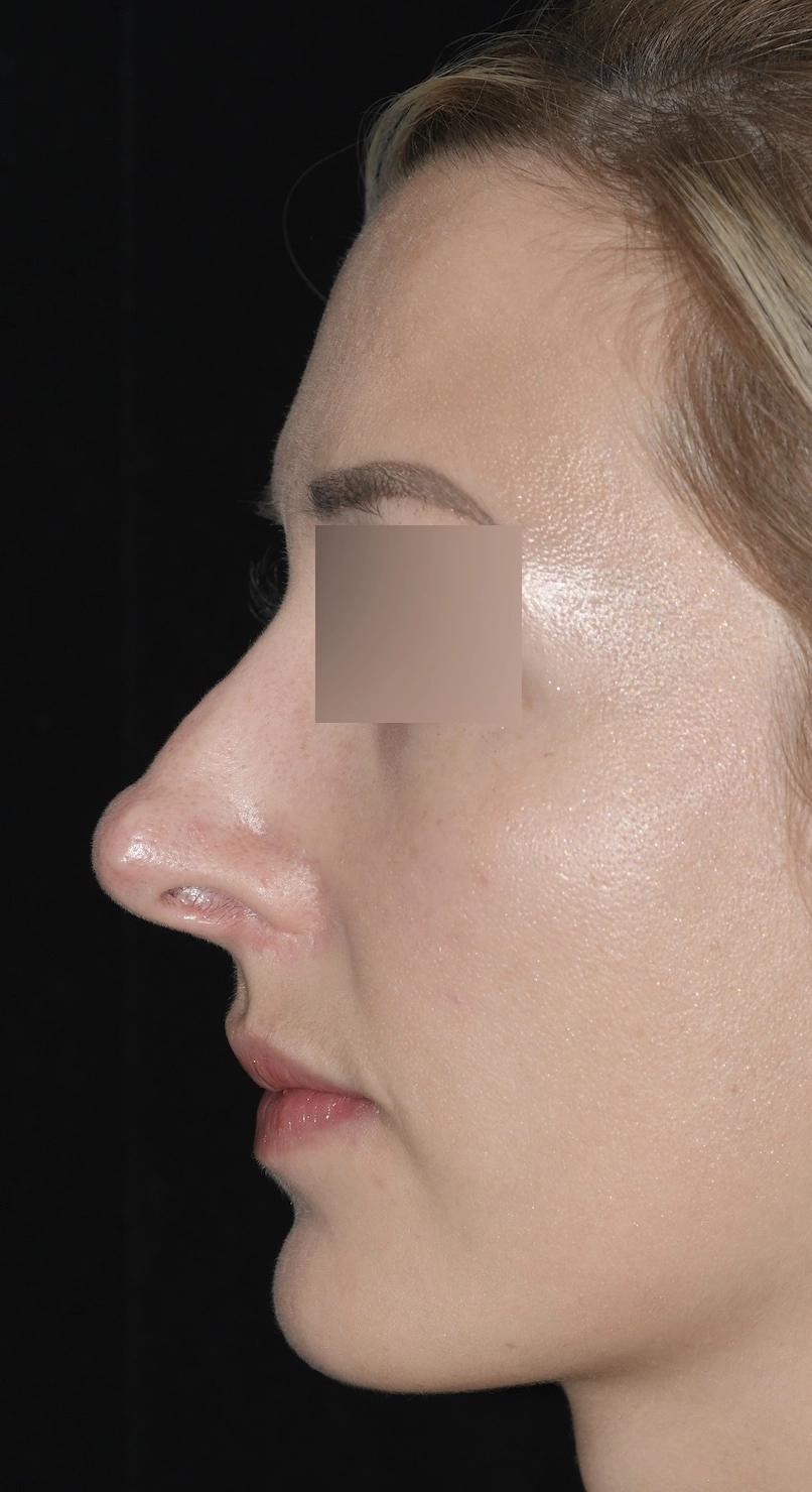 Revision rhinoplasty - Dr Carles