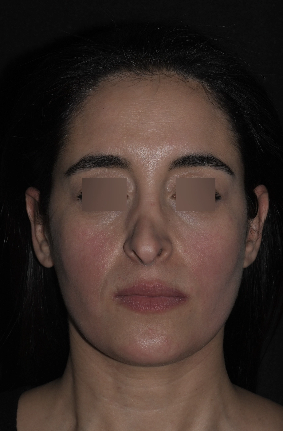 Revision rhinoplasty - Dr Carles