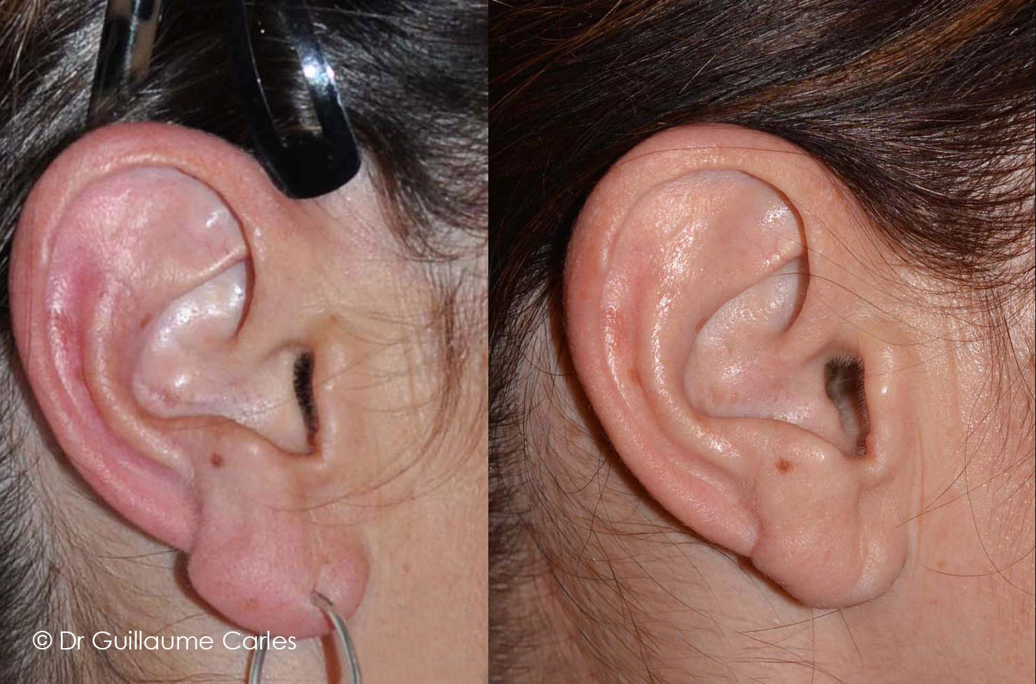 Otoplasty, protruding ears
