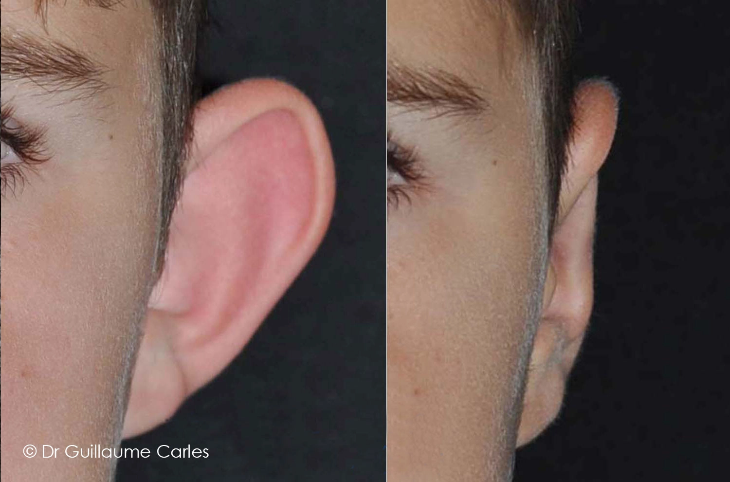 Protruding Ears
