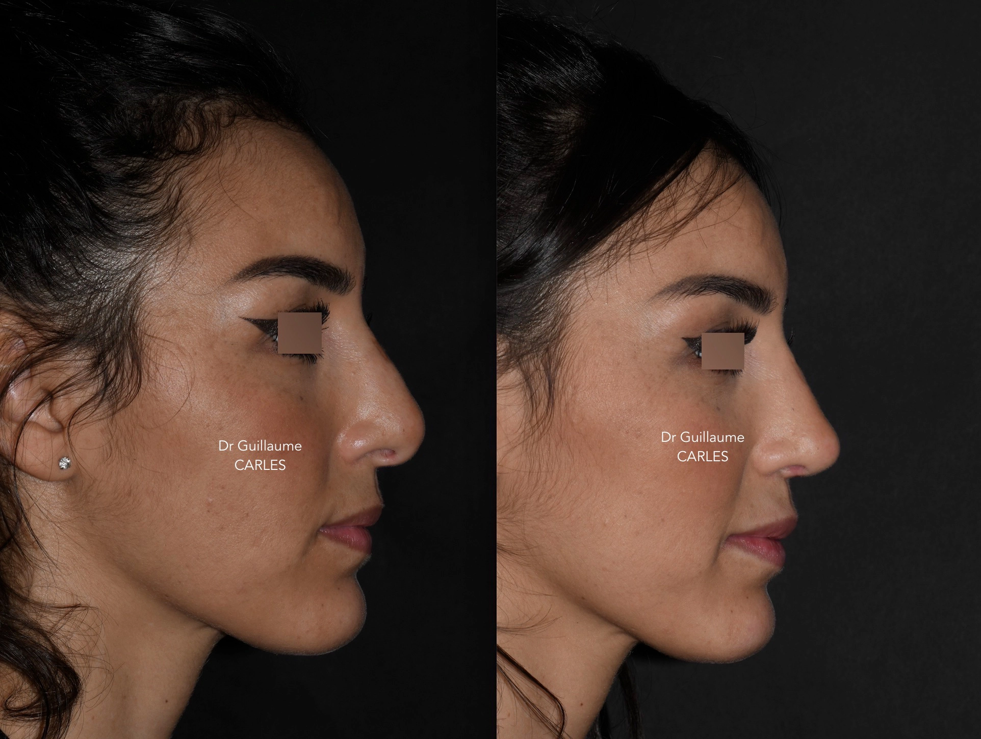 Les résultats avant/après de rhinoplastie secondaire - présentation de ...