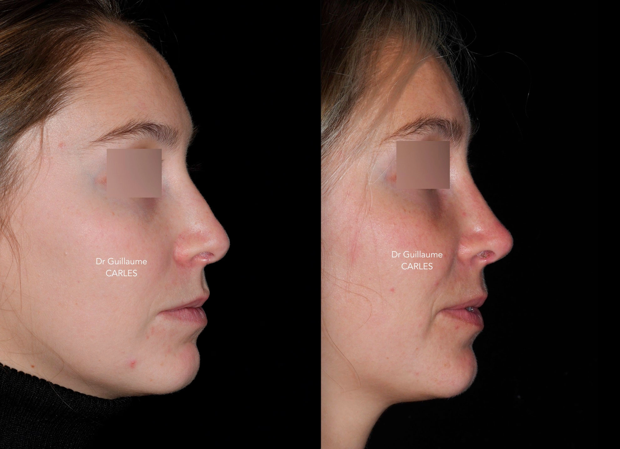 Les résultats avant/après de rhinoplastie secondaire - présentation de ...