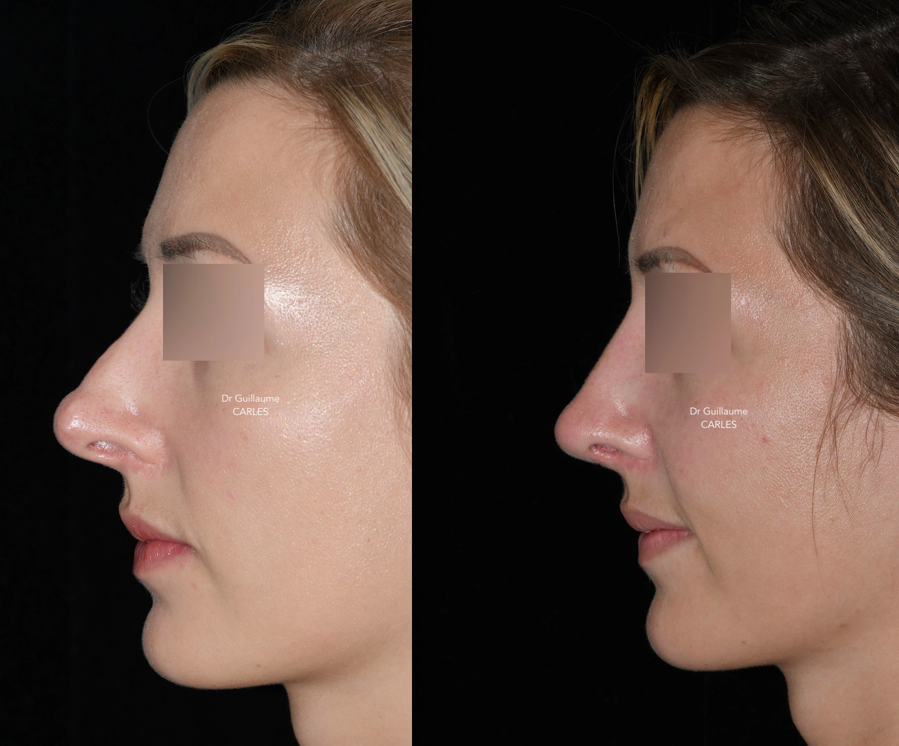 Les résultats avant/après de rhinoplastie secondaire - présentation de ...